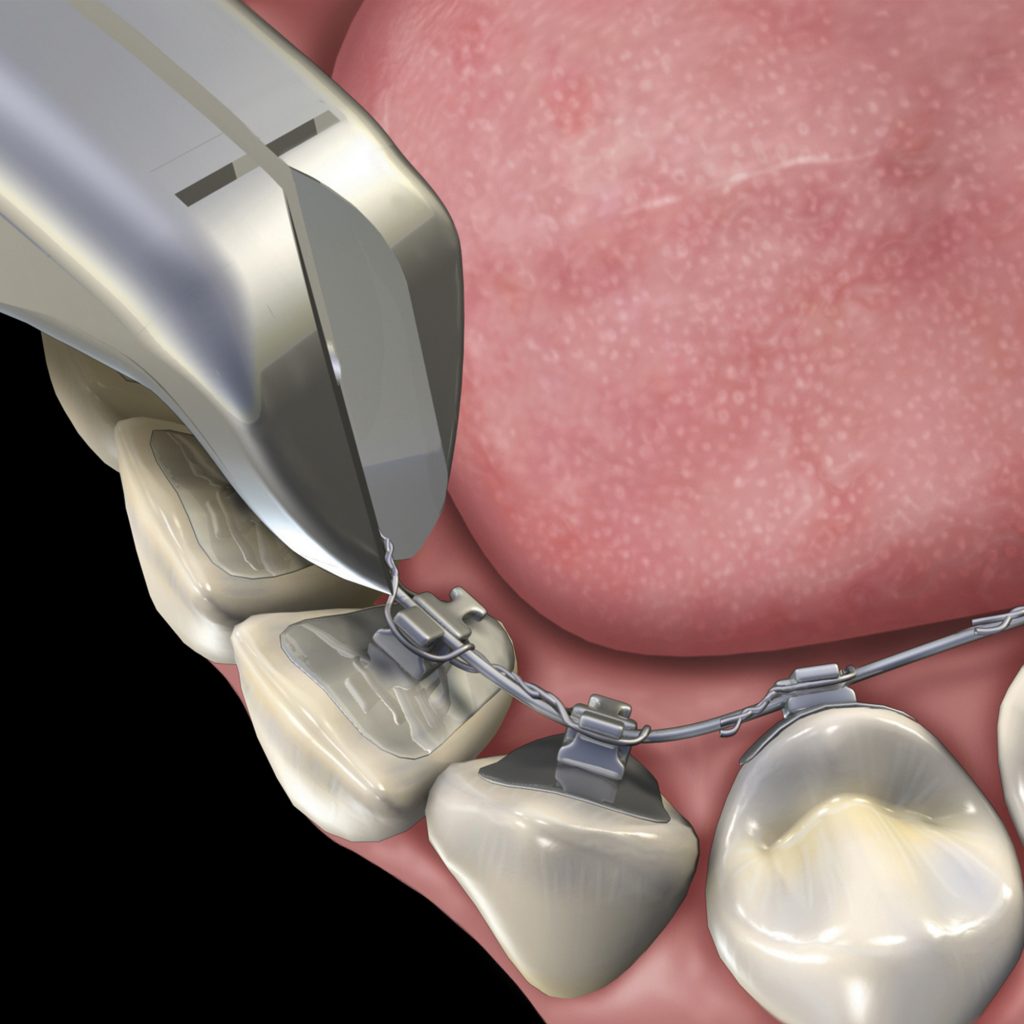 Ligature Cutters, Orthodontics, Hard Wire Cutters - A-Z Orthodontics