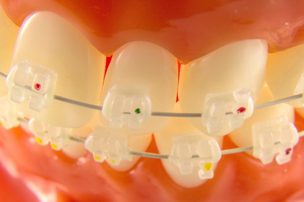 Smart Line® Ceramic Bracket Kits - A-Z Orthodontics