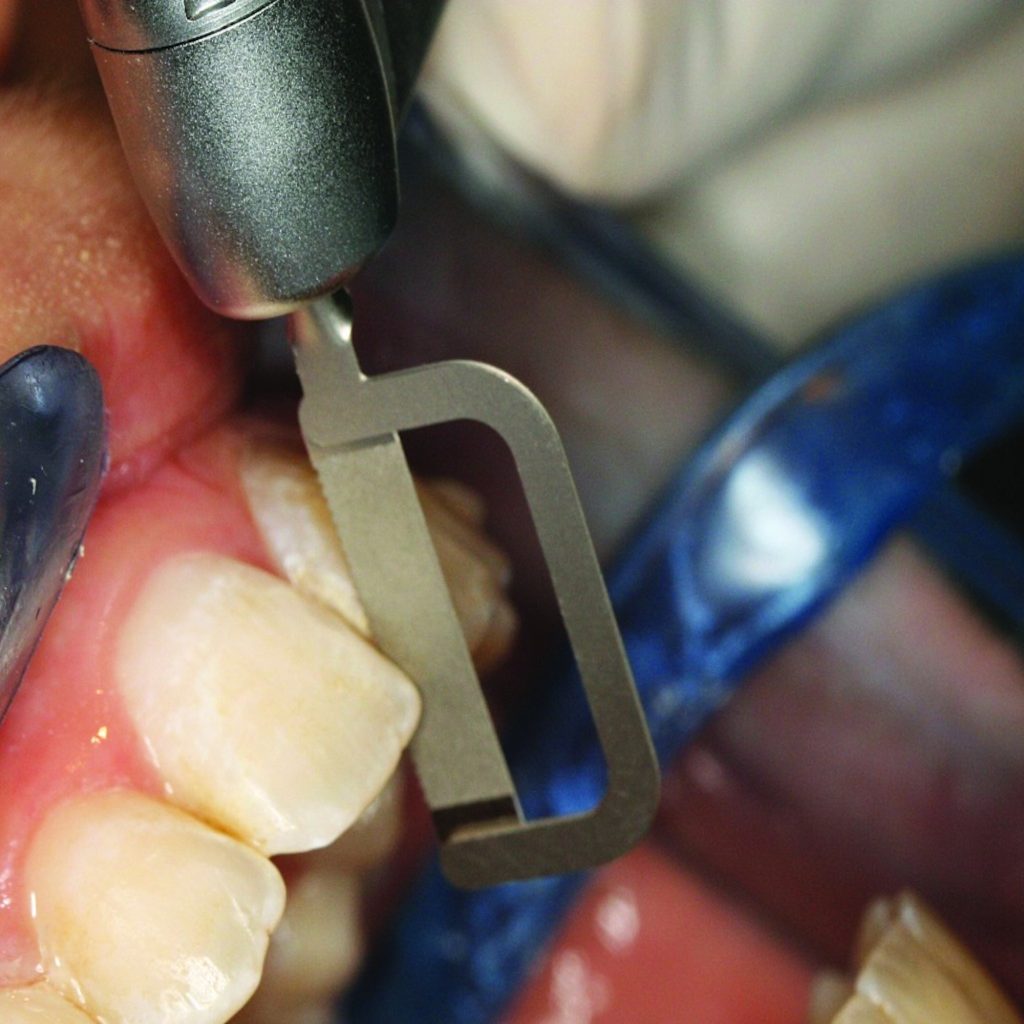 Intensiv Swingle Contra-Angle Handpiece without Light - A-Z Orthodontics