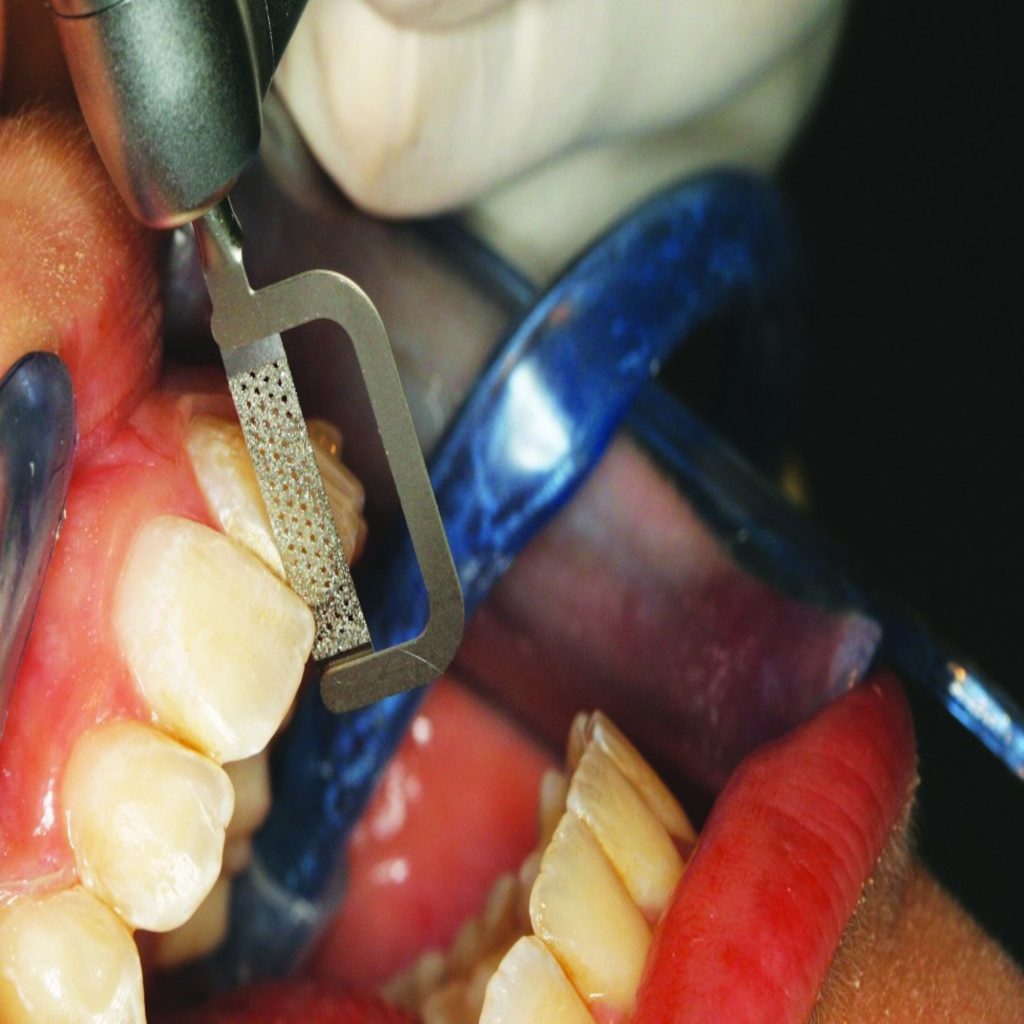 Intensiv Swingle Contra-Angle Handpiece without Light - A-Z Orthodontics