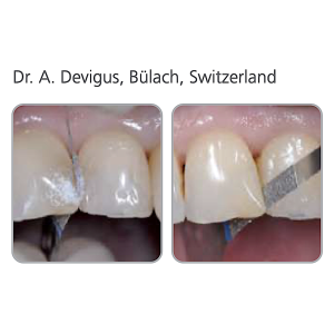 Interproximal Reduction & Burs - Orthodontic Supplies